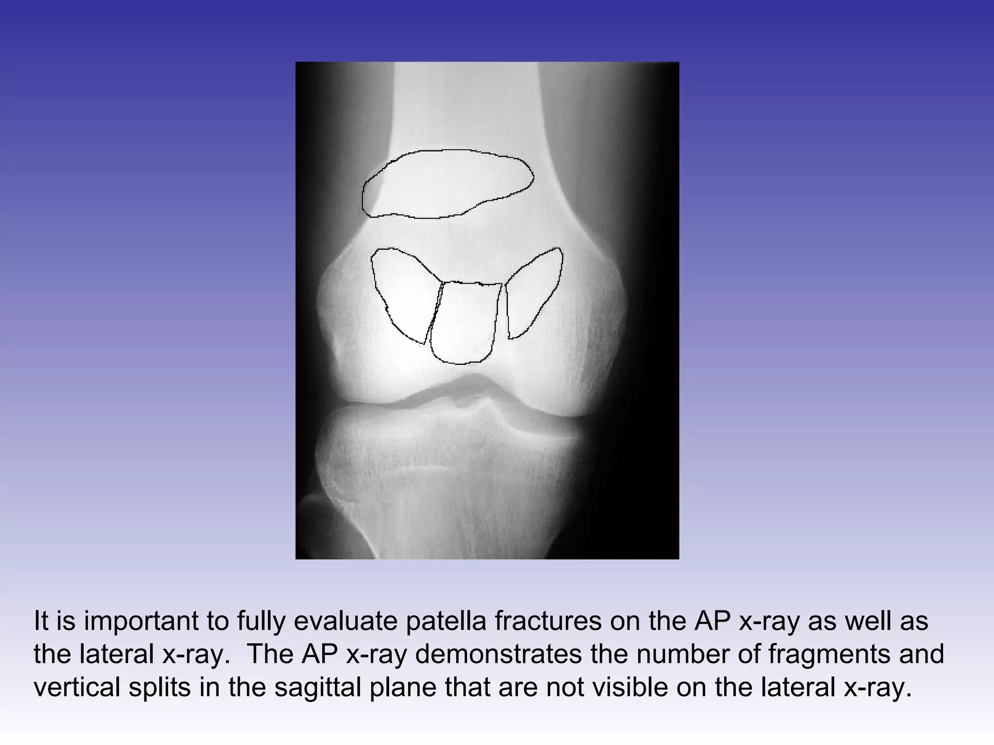 Patella | PPT