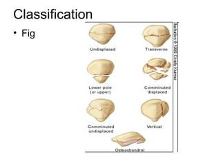 Patella Fracture Classification