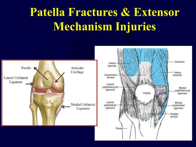 Patella fx and mechanism injuries | PPT