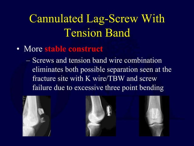 Patella fx and mechanism injuries | PPT