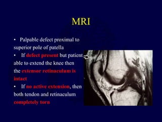 Patella fx and mechanism injuries | PPT