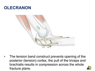 Patella and olecranon fractures | PPT
