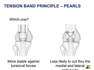 Patella and olecranon fractures | PPTX