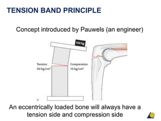 Patella and olecranon fractures | PPTX