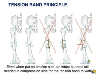 Patella and olecranon fractures | PPTX