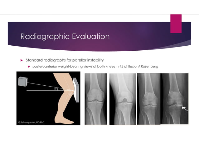 Patella Instability | PDF | Death, Injury, or Military Conflict ...