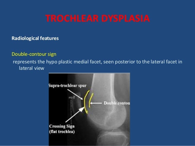 Patella dislocation by DR.NAVEEN RATHOR