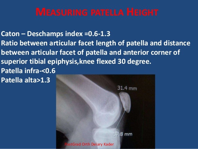 Patella dislocation by DR.NAVEEN RATHOR
