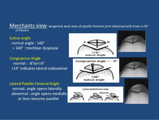 Patella dislocation by DR.NAVEEN RATHOR