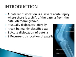 PATELLA DISLOCATION (1).pptx. . | PPT