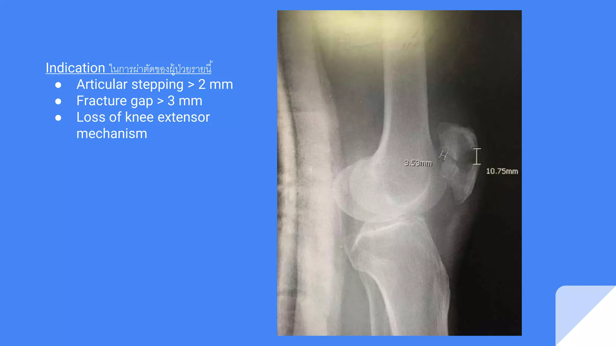 Patella fracture | PPTX
