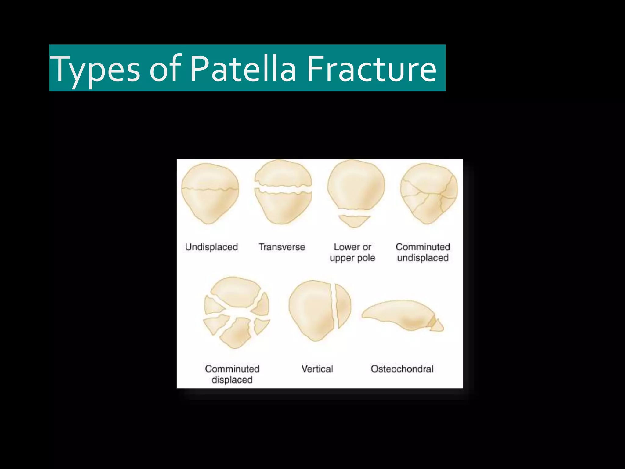 Patella fracture | PPTX