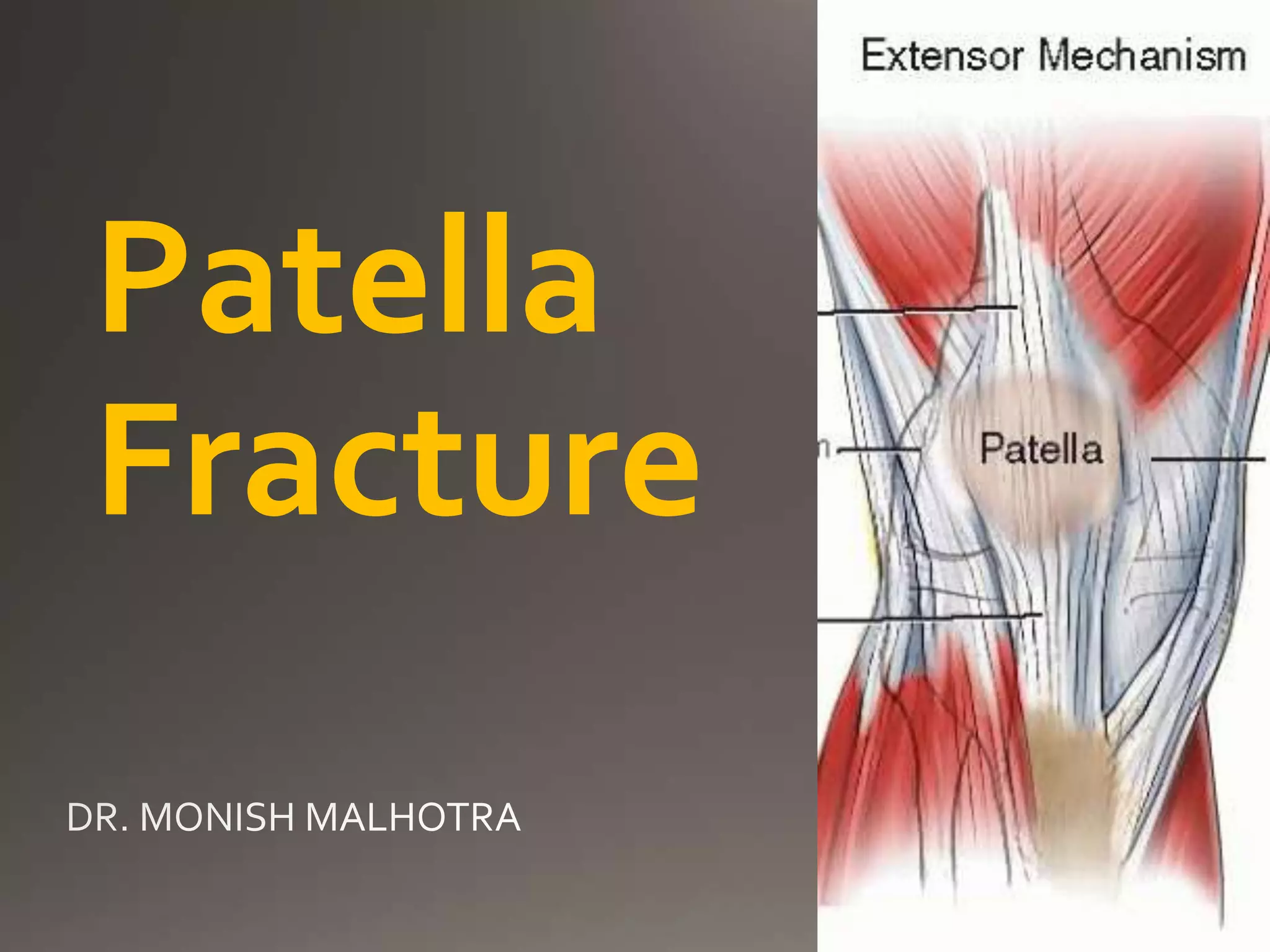 Patella fracture | PPT