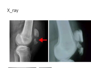 Patella Fracture and dislocation-WPS Office.pptx