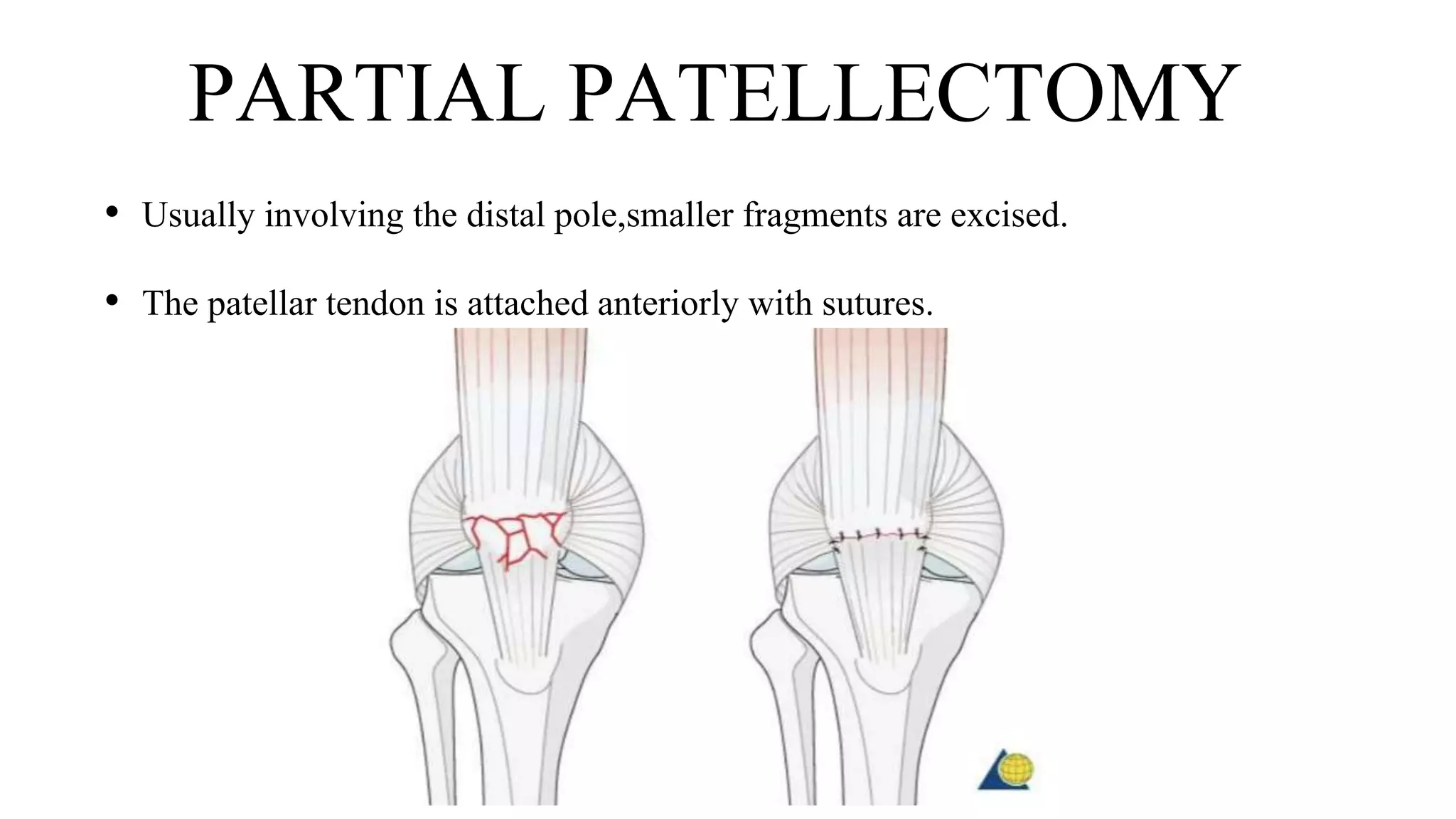 Patella fracture and tibial condyle fracture | PPTX