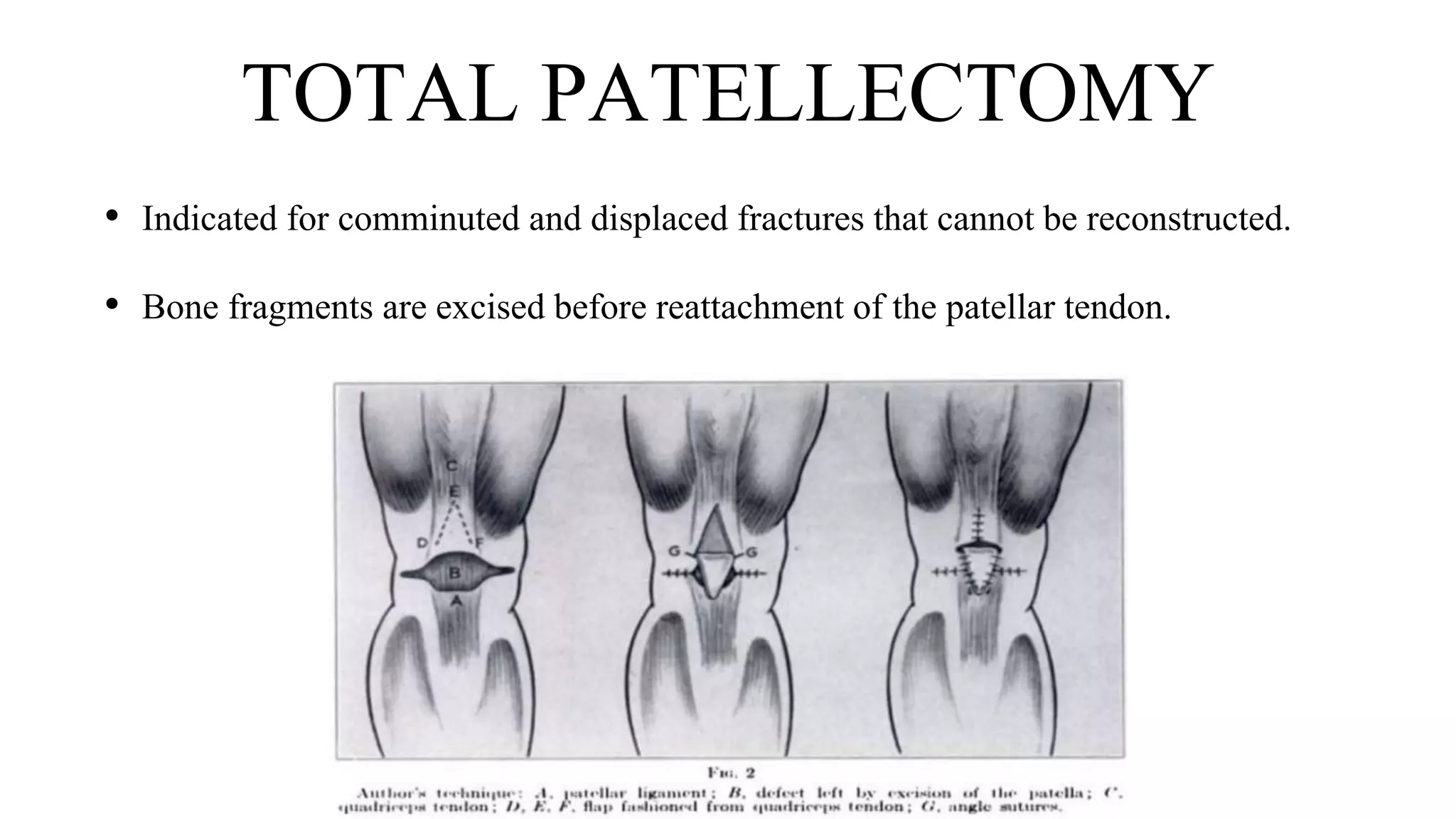 Patella fracture and tibial condyle fracture | PPTX