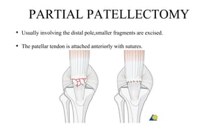 Patella fracture and tibial condyle fracture | PPTX