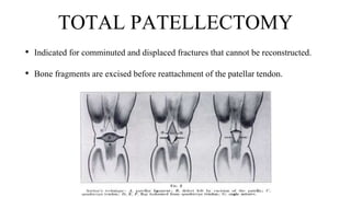 Patella fracture and tibial condyle fracture | PPTX