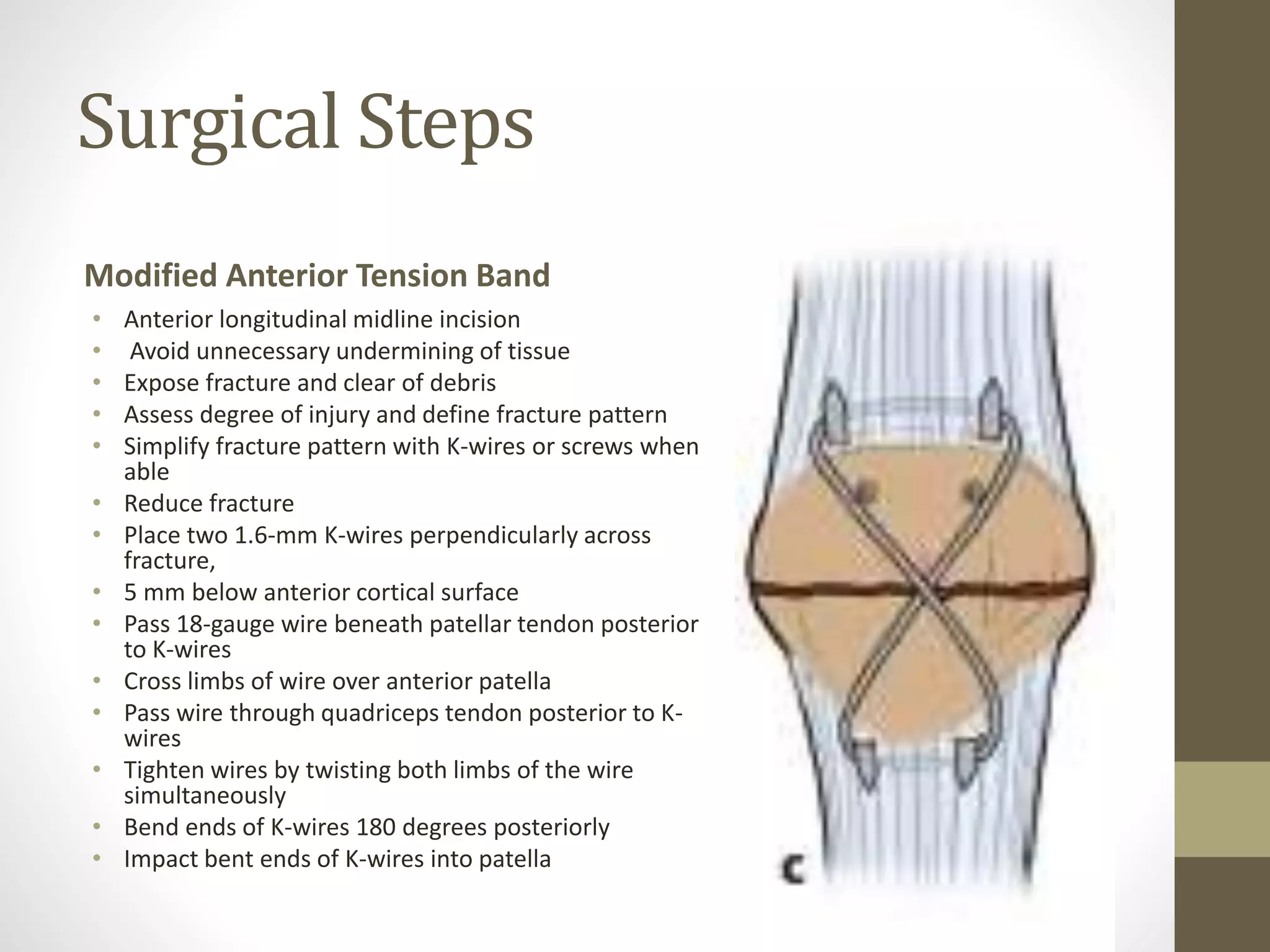 Patella fractures seminar mukul 11.06.2018