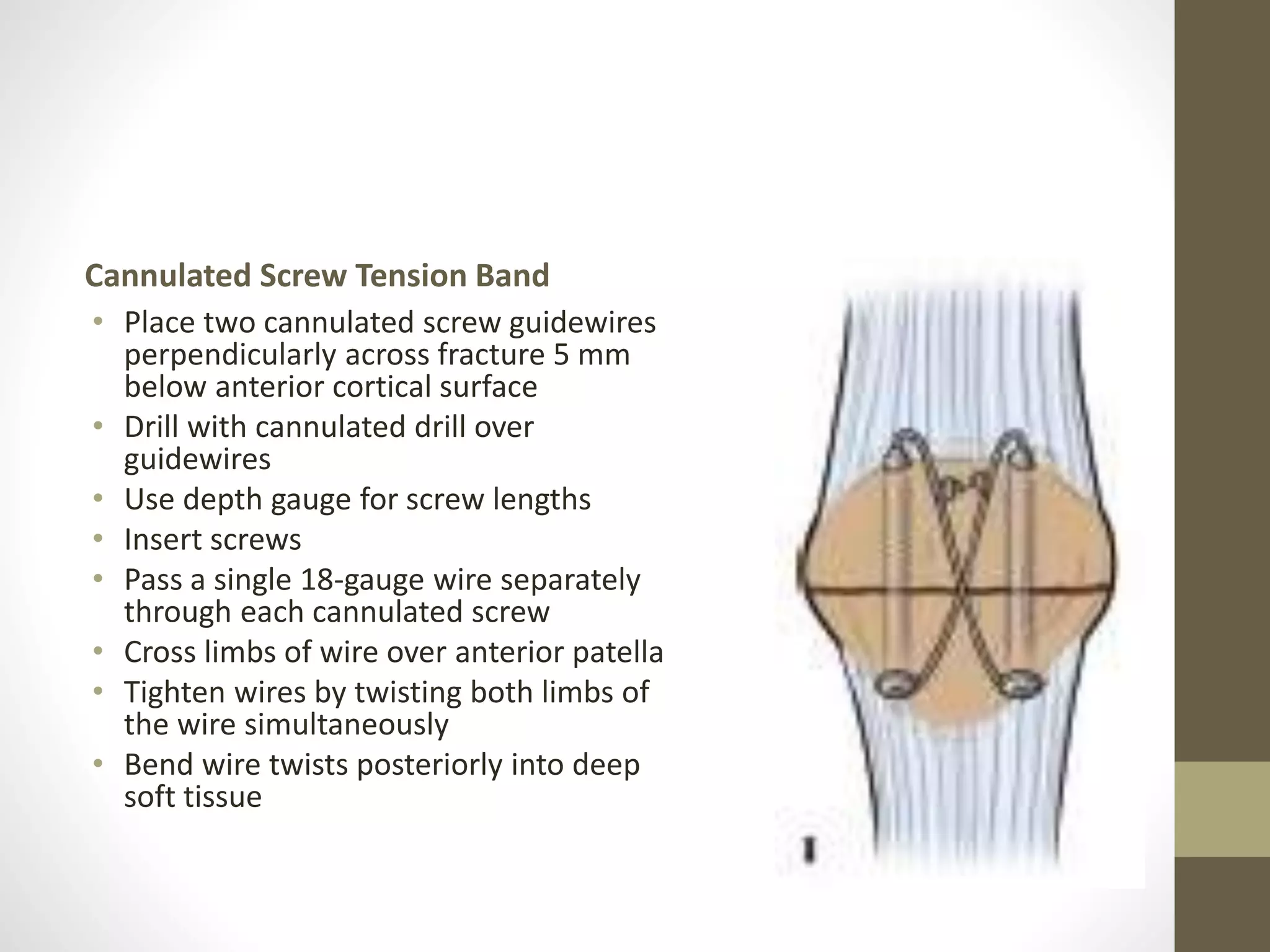 Patella fractures seminar mukul 11.06.2018