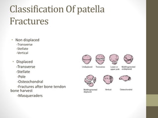 Patella fractures seminar mukul 11.06.2018