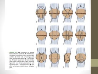Patella fractures seminar mukul 11.06.2018