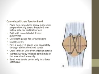 Patella fractures seminar mukul 11.06.2018