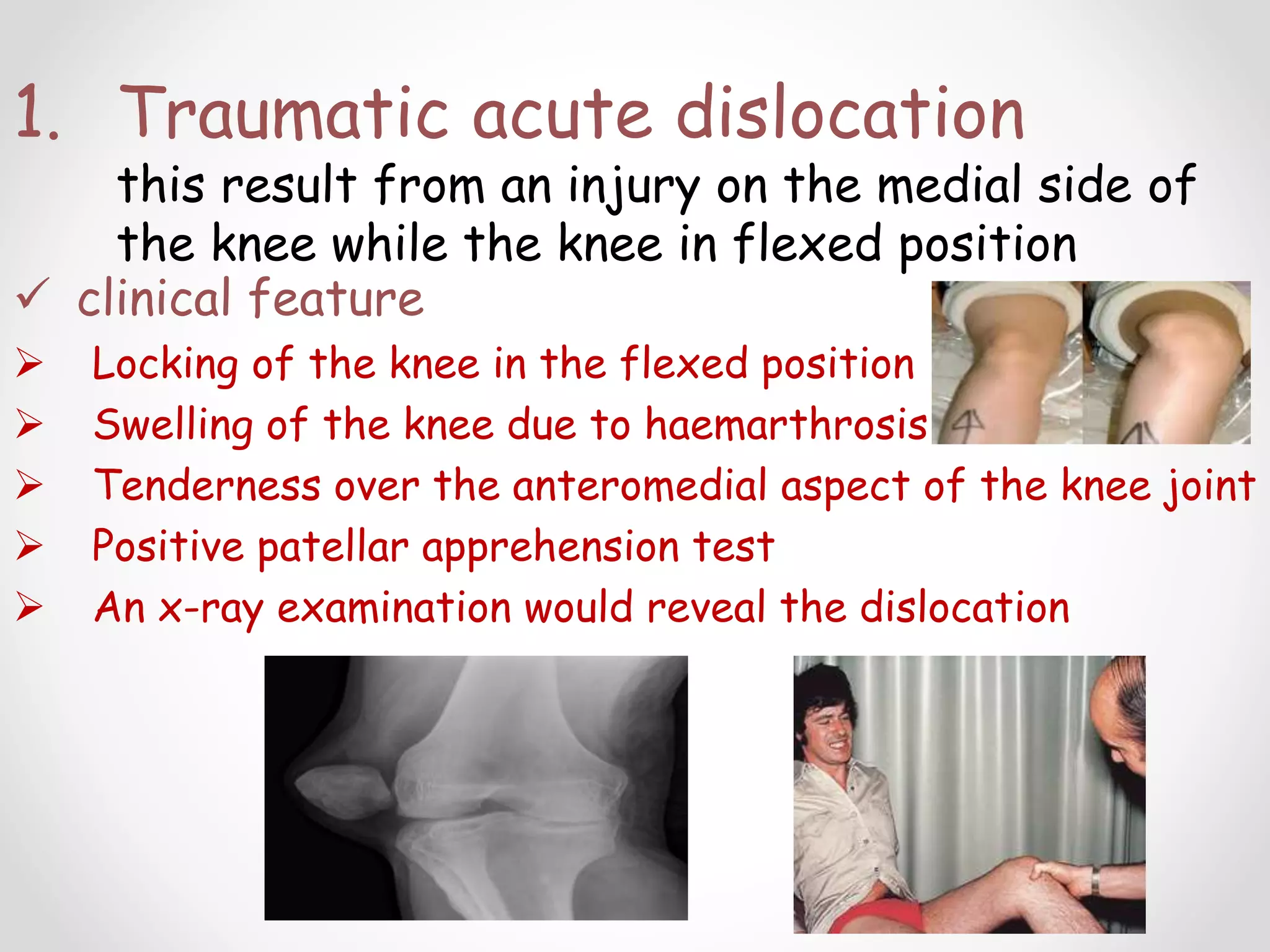 Patella and tibial plateau fractures | PPTX