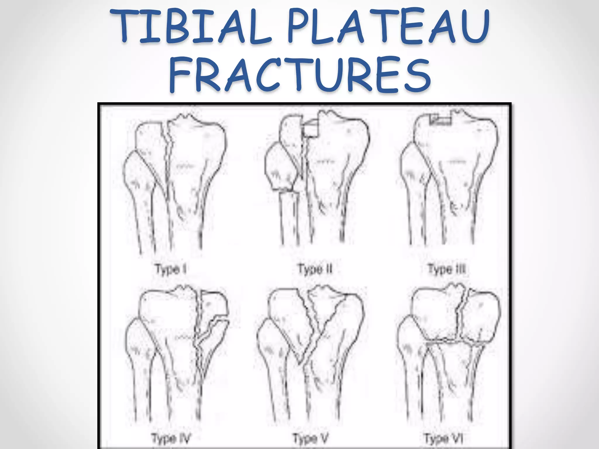 Patella and tibial plateau fractures | PPTX