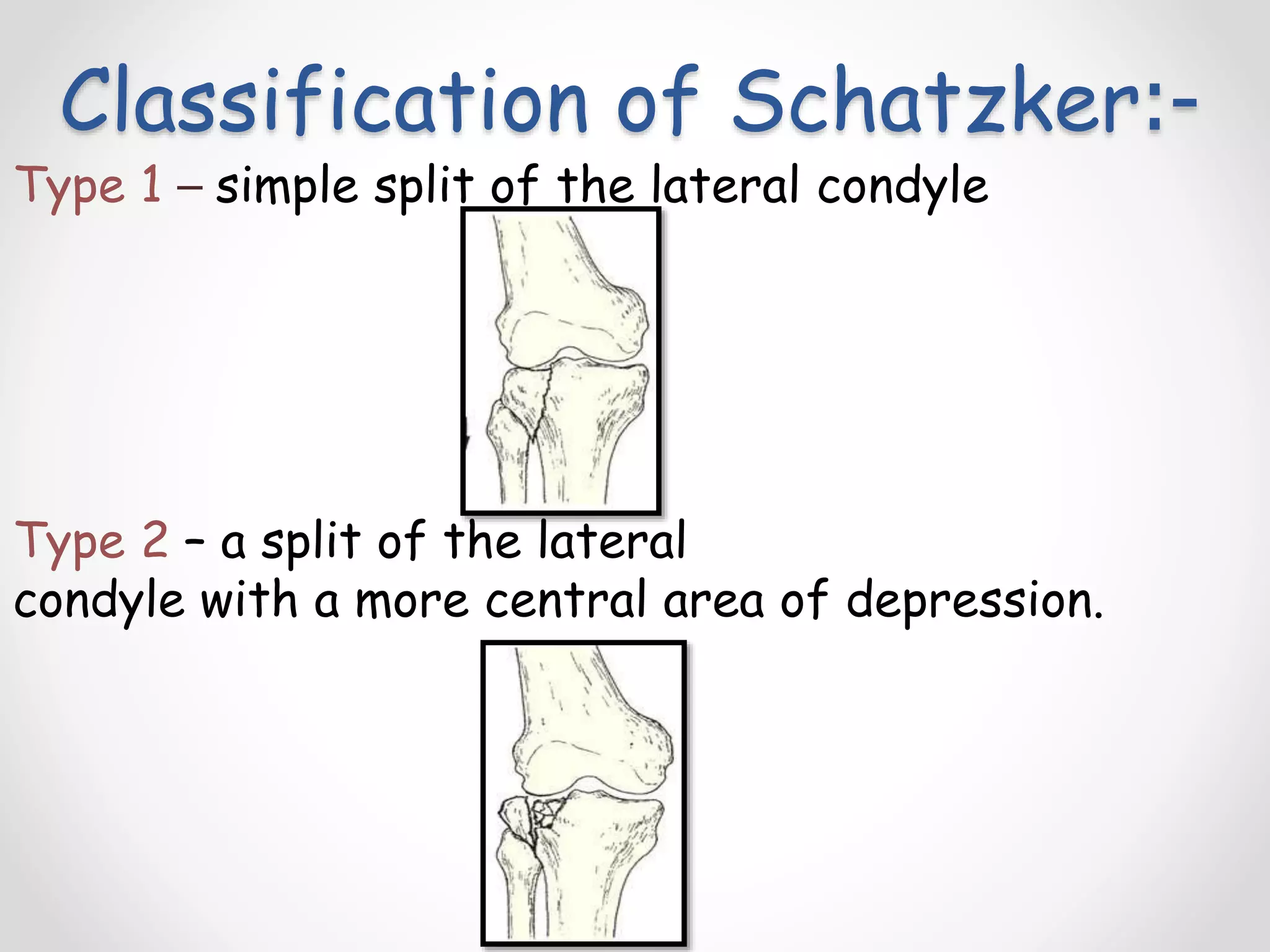 Patella and tibial plateau fractures | PPTX