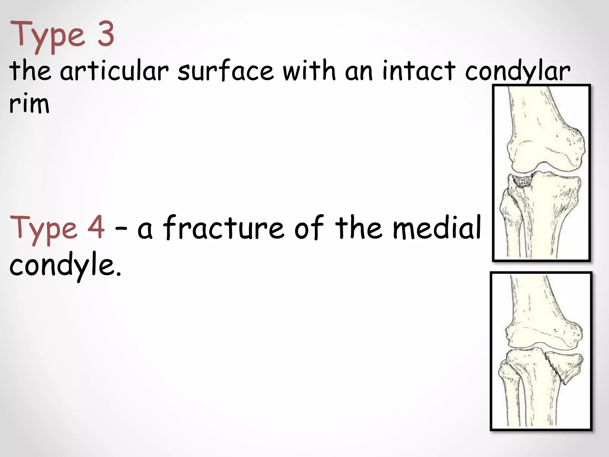 Patella and tibial plateau fractures | PPTX