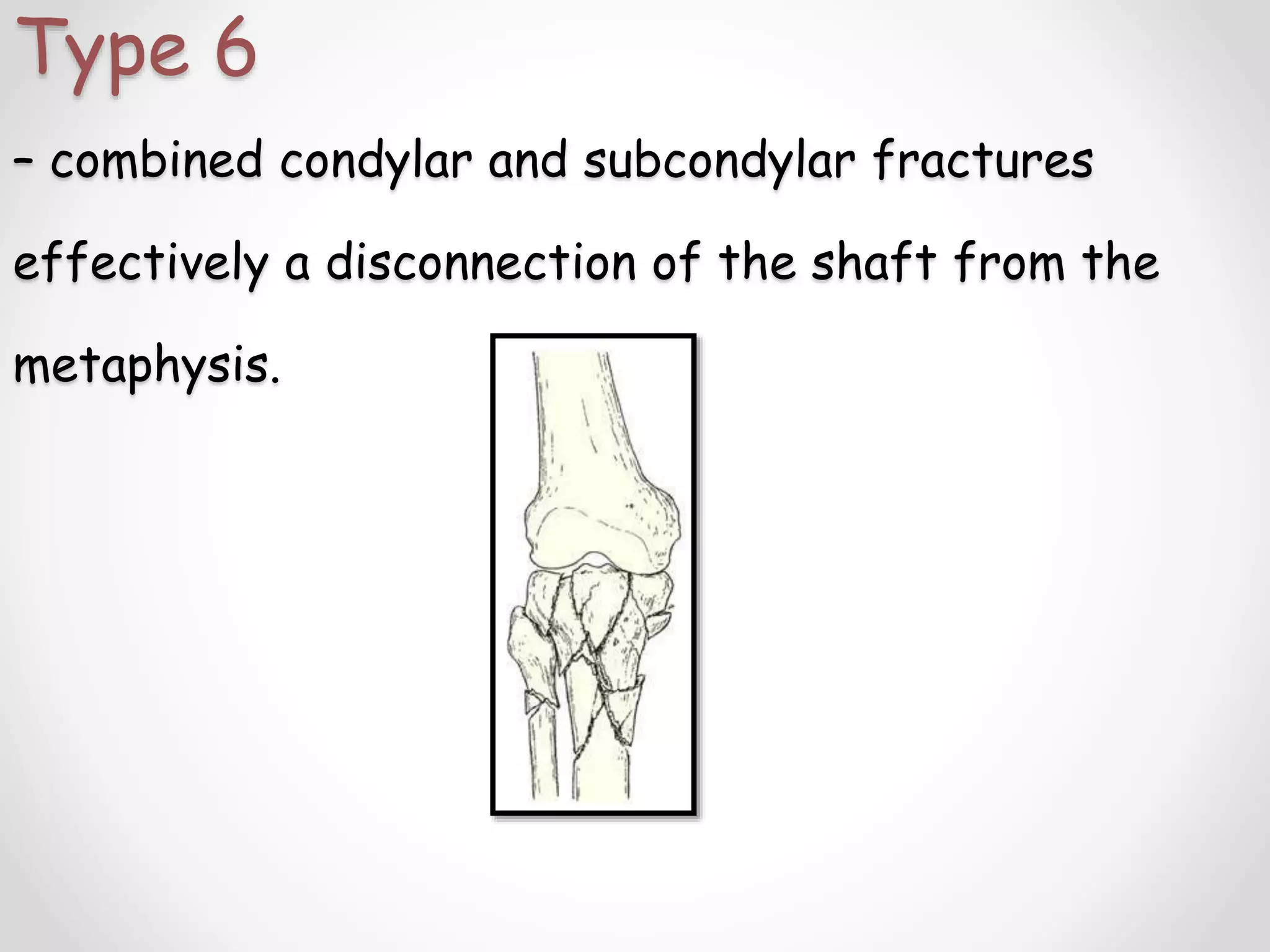 Patella and tibial plateau fractures | PPTX