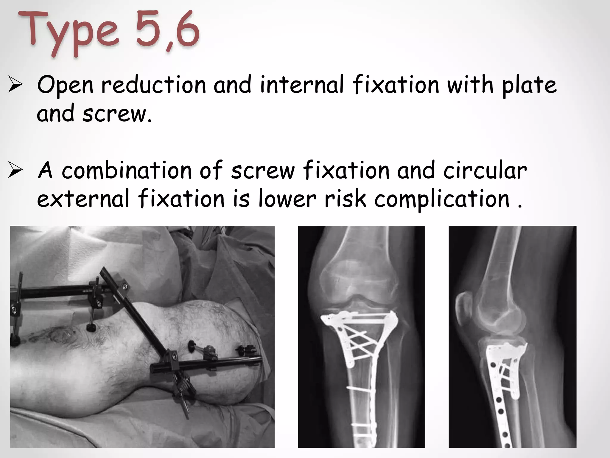 Patella and tibial plateau fractures | PPTX