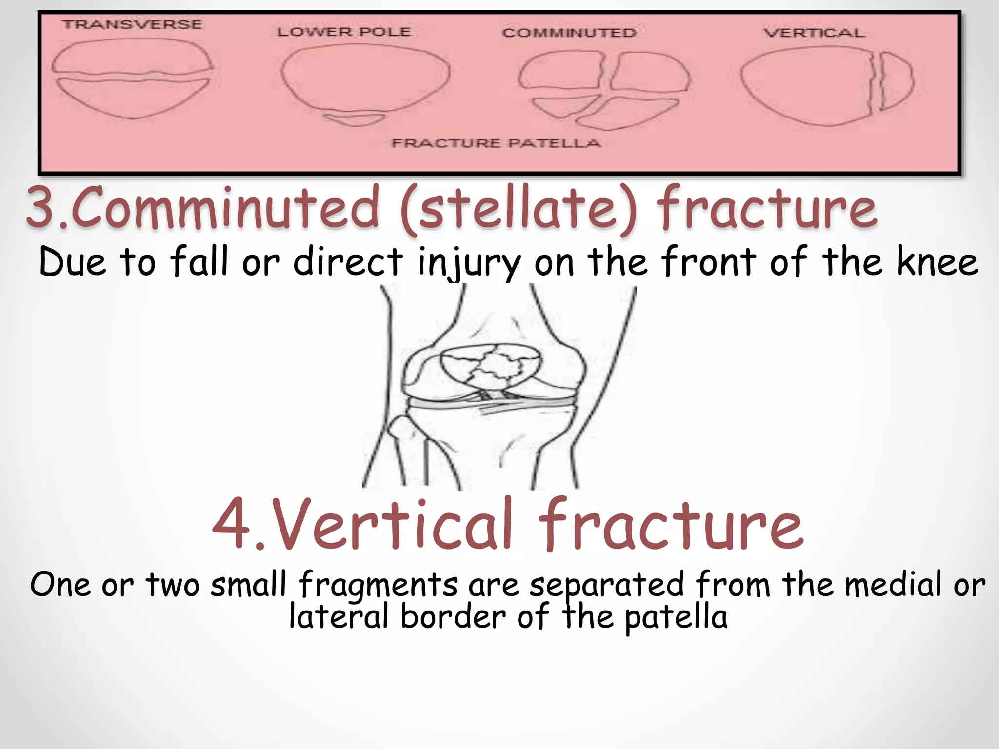Patella and tibial plateau fractures | PPTX