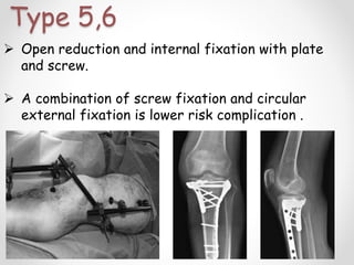 Patella and tibial plateau fractures | PPTX