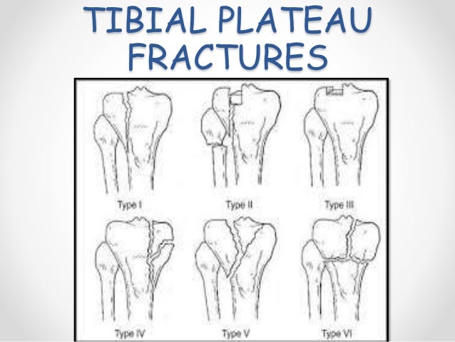 Patella and tibial plateau fractures
