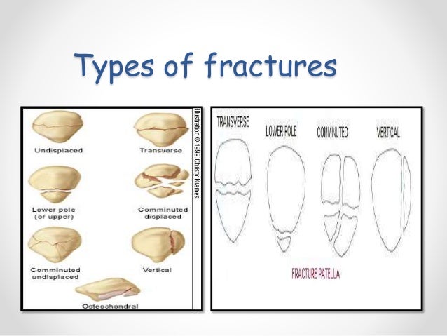 Patella and tibial plateau fractures