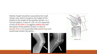 Patella fractures and extensor mechanism injuries | PPTX