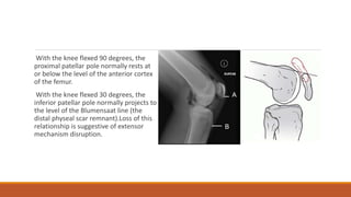 Patella fractures and extensor mechanism injuries | PPT