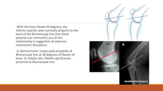 Patella fractures and extensor mechanism injuries | PPTX