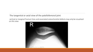 Patella fractures and extensor mechanism injuries | PPTX