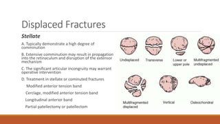 Patella fractures and extensor mechanism injuries | PPTX