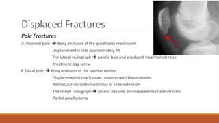 Patella fractures and extensor mechanism injuries | PPTX