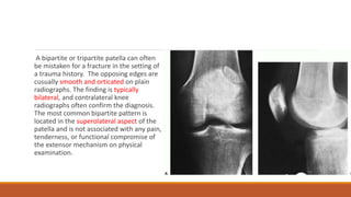 Patella fractures and extensor mechanism injuries | PPTX
