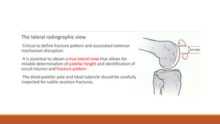 Patella fractures and extensor mechanism injuries | PPTX