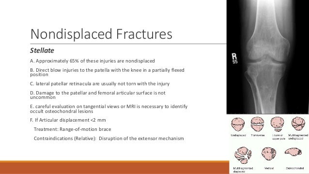 Patella fractures and extensor mechanism injuries