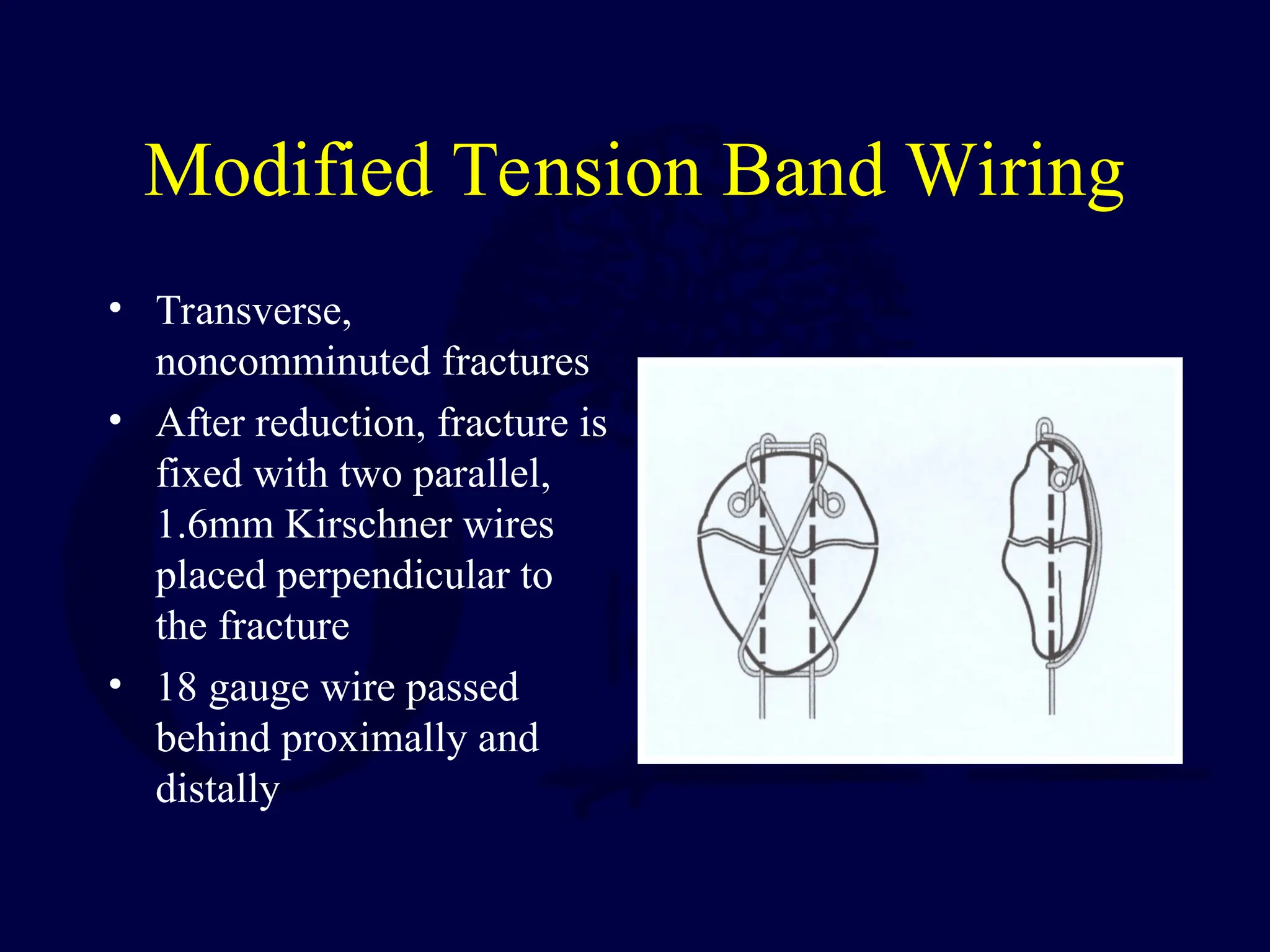 Patella Fractures & Extensor Mechanism Injuries.ppt