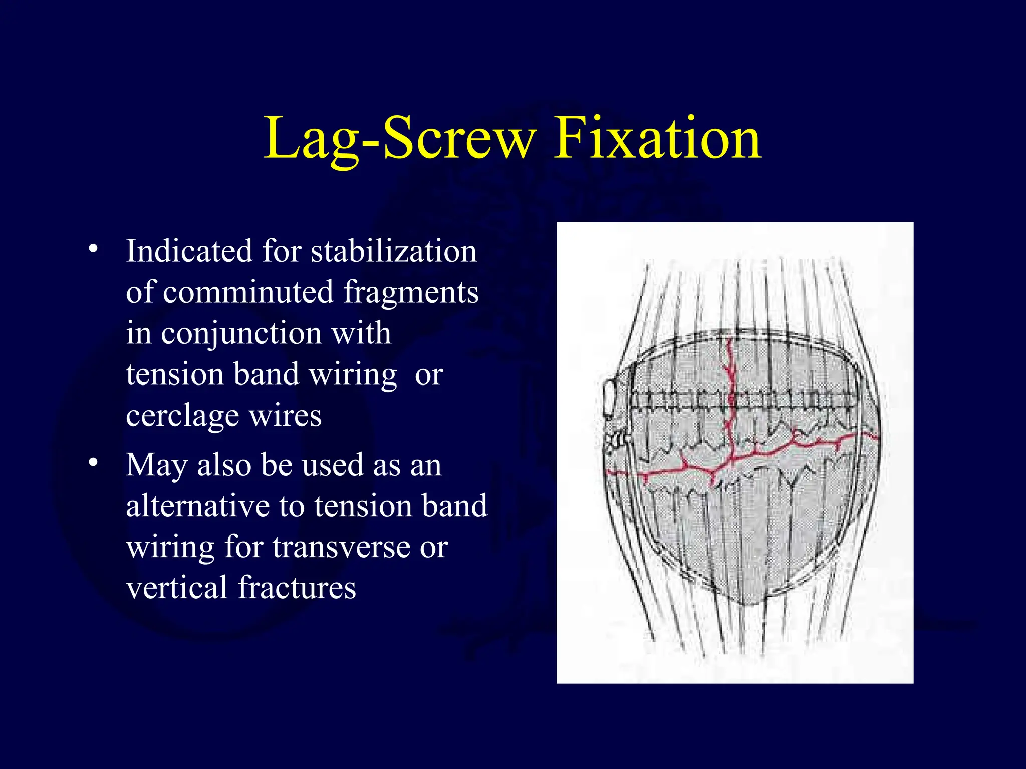 Patella Fractures & Extensor Mechanism Injuries.ppt