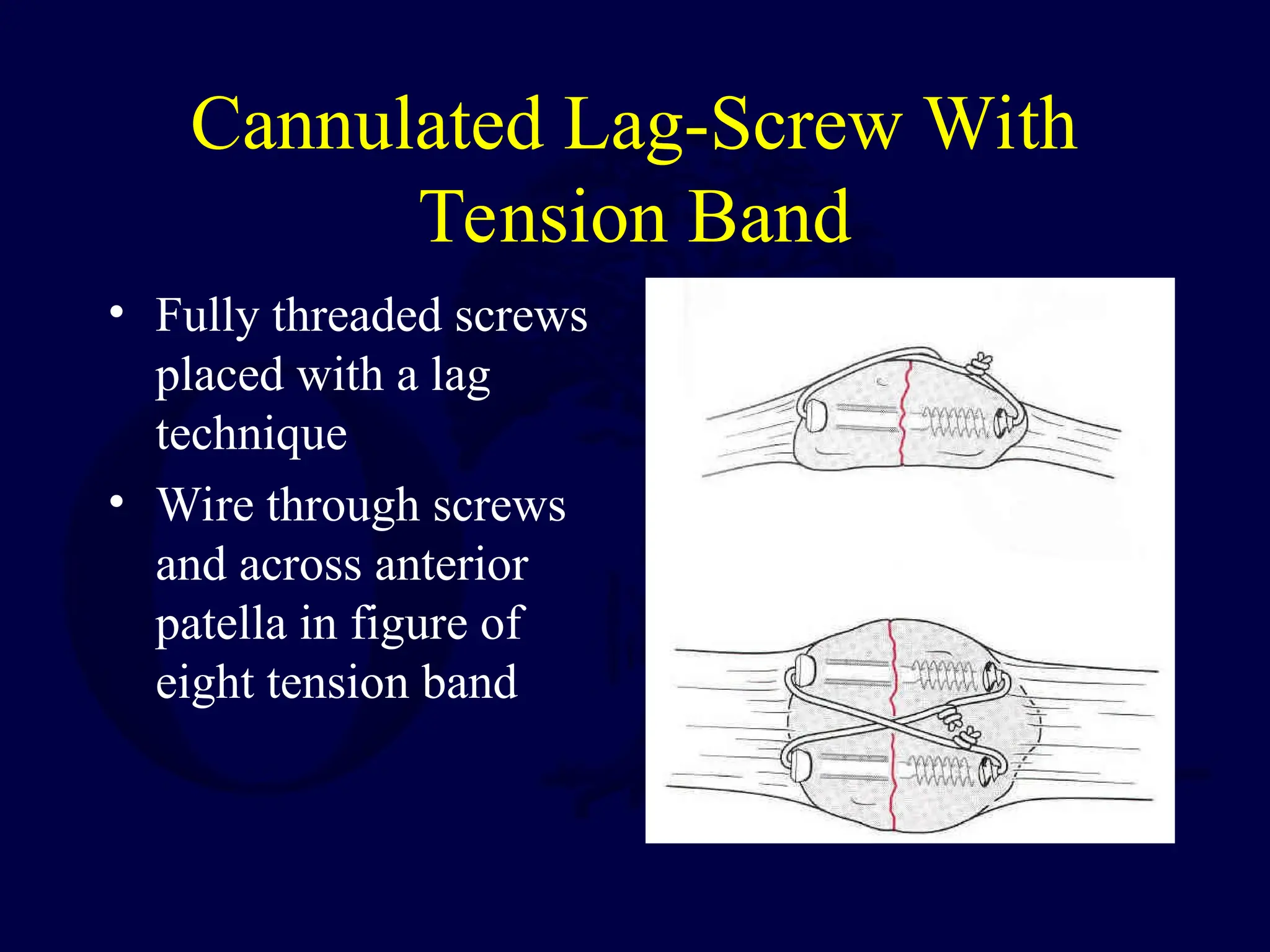 Patella Fractures & Extensor Mechanism Injuries.ppt