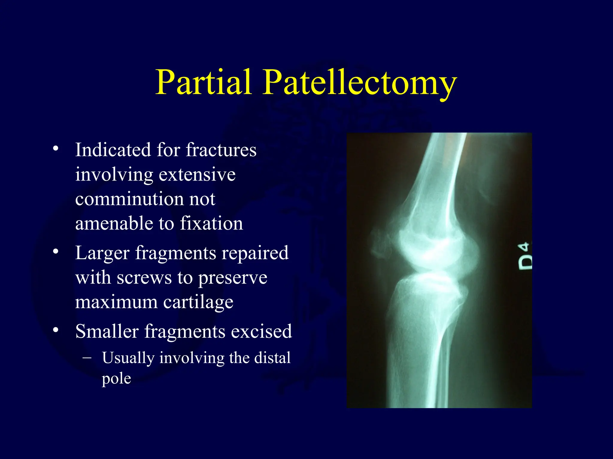 Patella Fractures & Extensor Mechanism Injuries.ppt